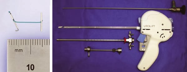 UROLIFT: los clips prostáticos