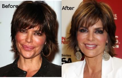Lisa Rinna Lips Before And After