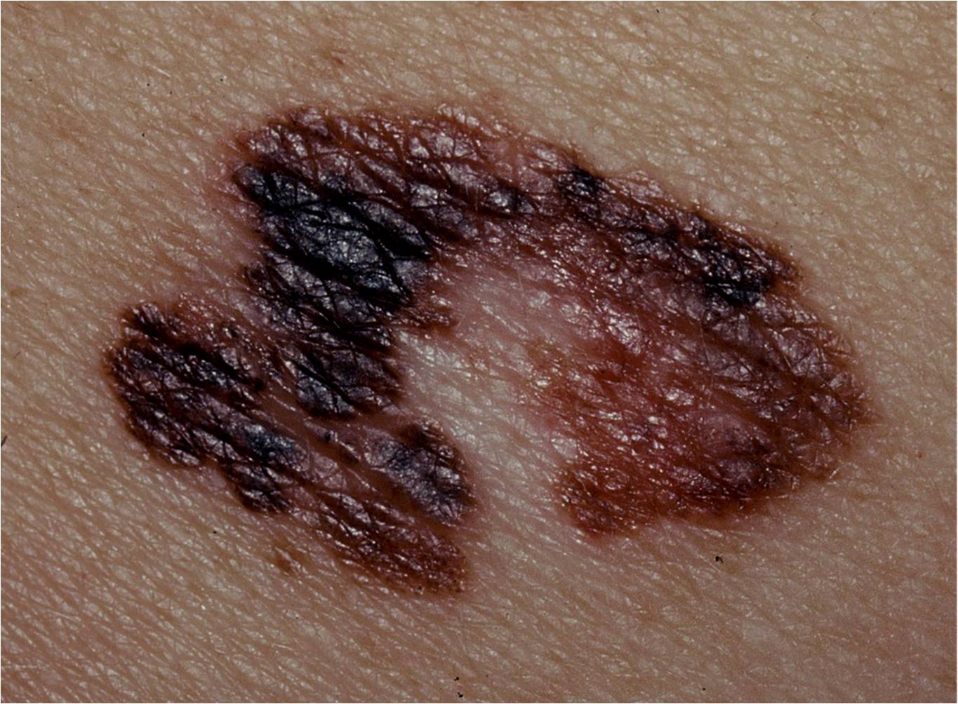 This is Me, Martina: Melanoma update!!