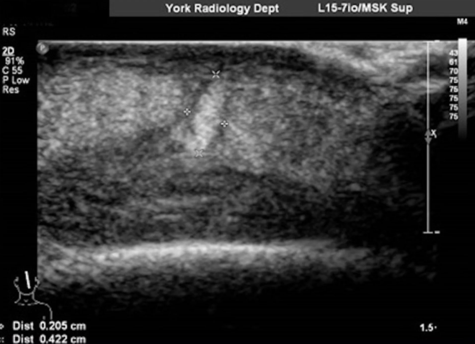 Maggot Was Found In This Woman's Head - BAMIDALES BLOG