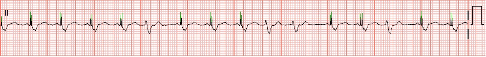 EKG Rhythm Strips 23: Paced Rhythms