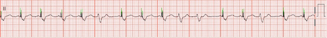 EKG Rhythm Strips 23: Paced Rhythms