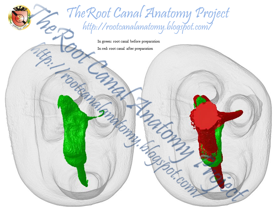 The Root Canal Anatomy Project: Conservative Endodontic Access ...