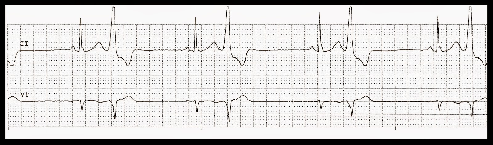 EKG Rhythm Quiz 279