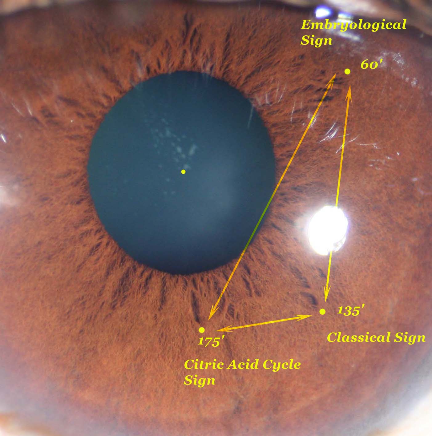 Modern & Multidimensional Iridology: Iris Signs at Internal & External ...