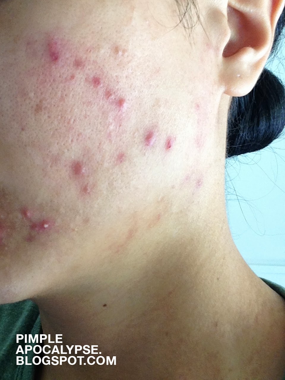 pimple apocalypse: How it started....