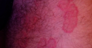 Dermatitis Numularis / Penyakit Kulit