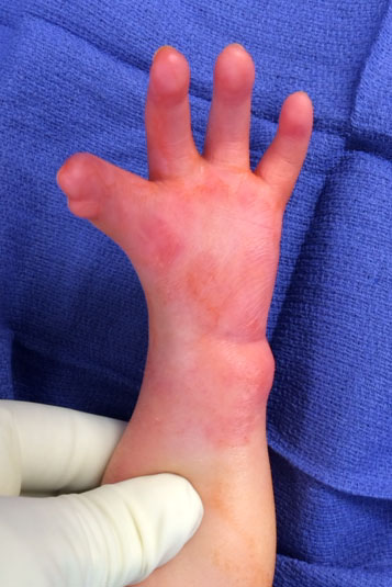 Not the Typical Thumb and Wrist | Congenital Hand and Arm Differences ...