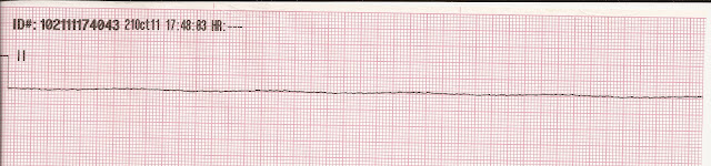 EKG Rhythm Strip Quiz 23