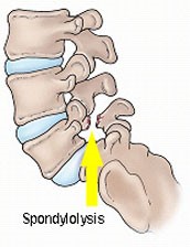 What is Spondylolysis or a Pars Fracture? | Growing Spine Blog ...