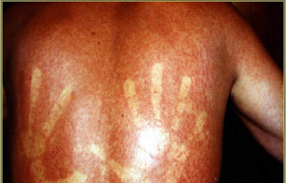 Dengue: Dengue Hemorrágico: