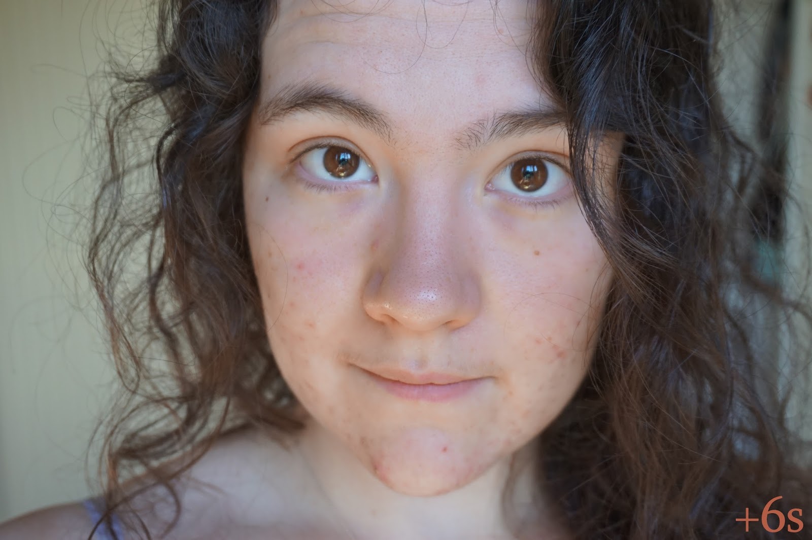 At War with Acne: Cicalfate & TriAcnéal Expert (Avène) won ! - Flavour ...