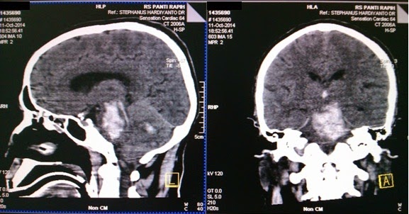 MS: TEKNIK PEMERIKSAAN CT-SCAN KEPALA PADA KASUS AFASIA DI INSTALASI ...