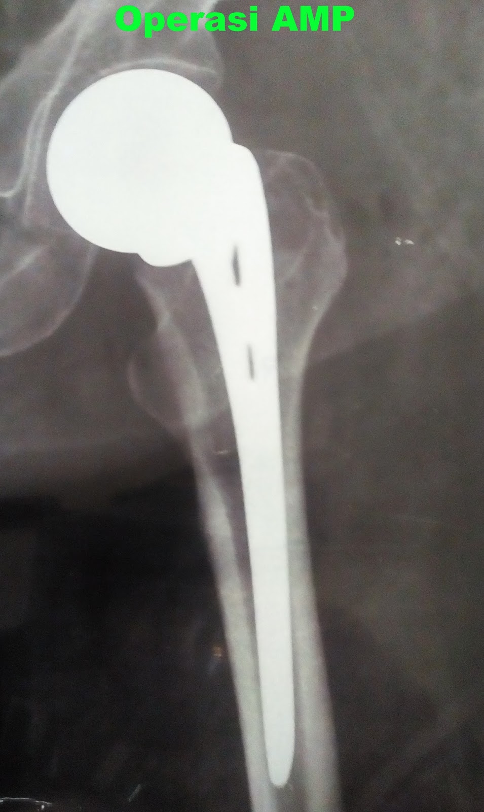 Latihan Pasca Ganti Sendi Panggul Saat di Rumah Sakit ~ Sendi, Tulang ...