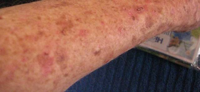 Going Grey and Slightly Green: The Joys of Efudix