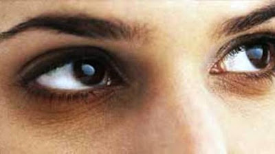 Cantik Alami, kecantikan lebih lama: Cara Mengatasi Kelopak Mata Hitam