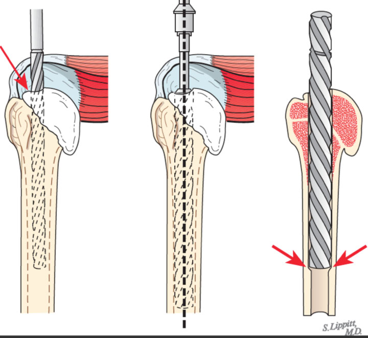 UW Shoulder and Elbow Academy: Shoulder joint replacement step by step ...