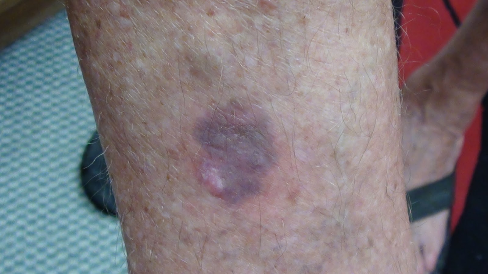 Consultations in Dermatoscopy: Pink and Purple