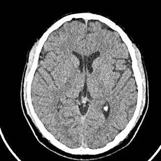 Ultimate Radiology : Multiple Cavernomas in Brain