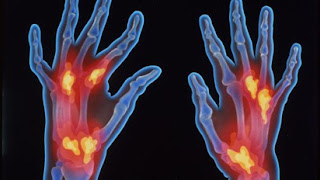 Quiromasaje y otras terapias: Que es el Reumatismo muscular? Que ...