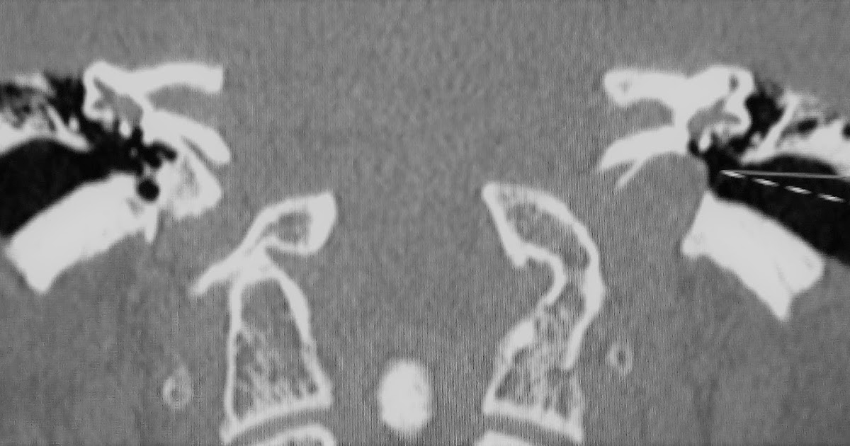 Dehiscent jugular bulb : CT - Sumer's Radiology Blog