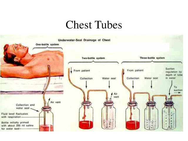 Pemasangan WSD (Water Seal Drainage) / Chest Tubes