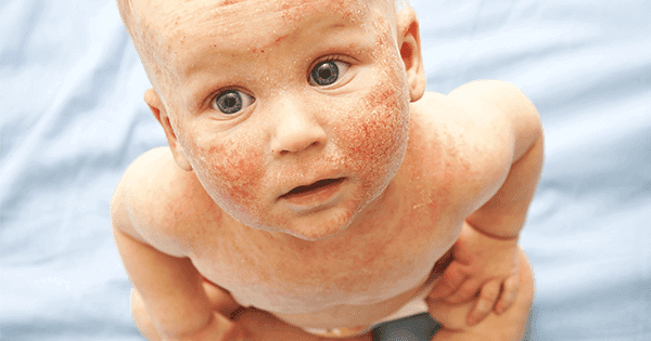 Eczema in Babies - Causes, Prevention and Treatment