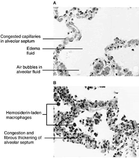 Kelainan Hemodiamik, Penyakit Tromboembolik, dan Syok | MediBlock