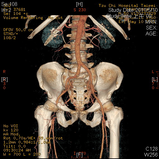 淨元法師之大醫院小醫師: right CFA saddle thrombus status post type A dissection ...