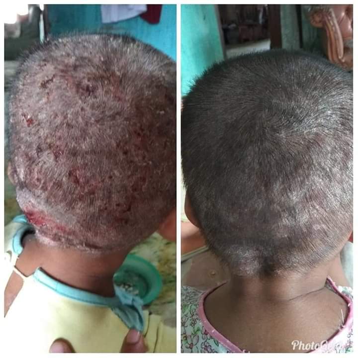 HalalMart HNI Langsa Baro: Borokan, Gatal-gatal Sembuh, Alhamdulillah