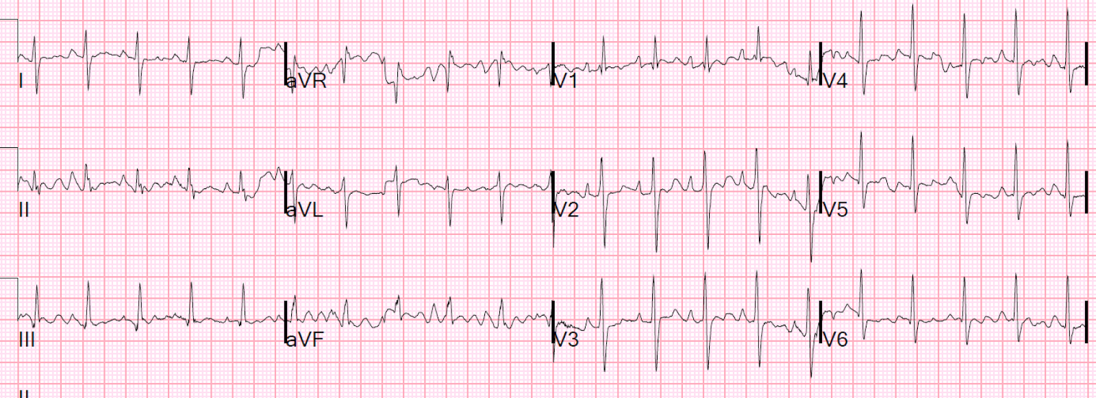Dr. Smith's ECG Blog: Acute Respiratory Distress, Hypoxia, and a Large ...