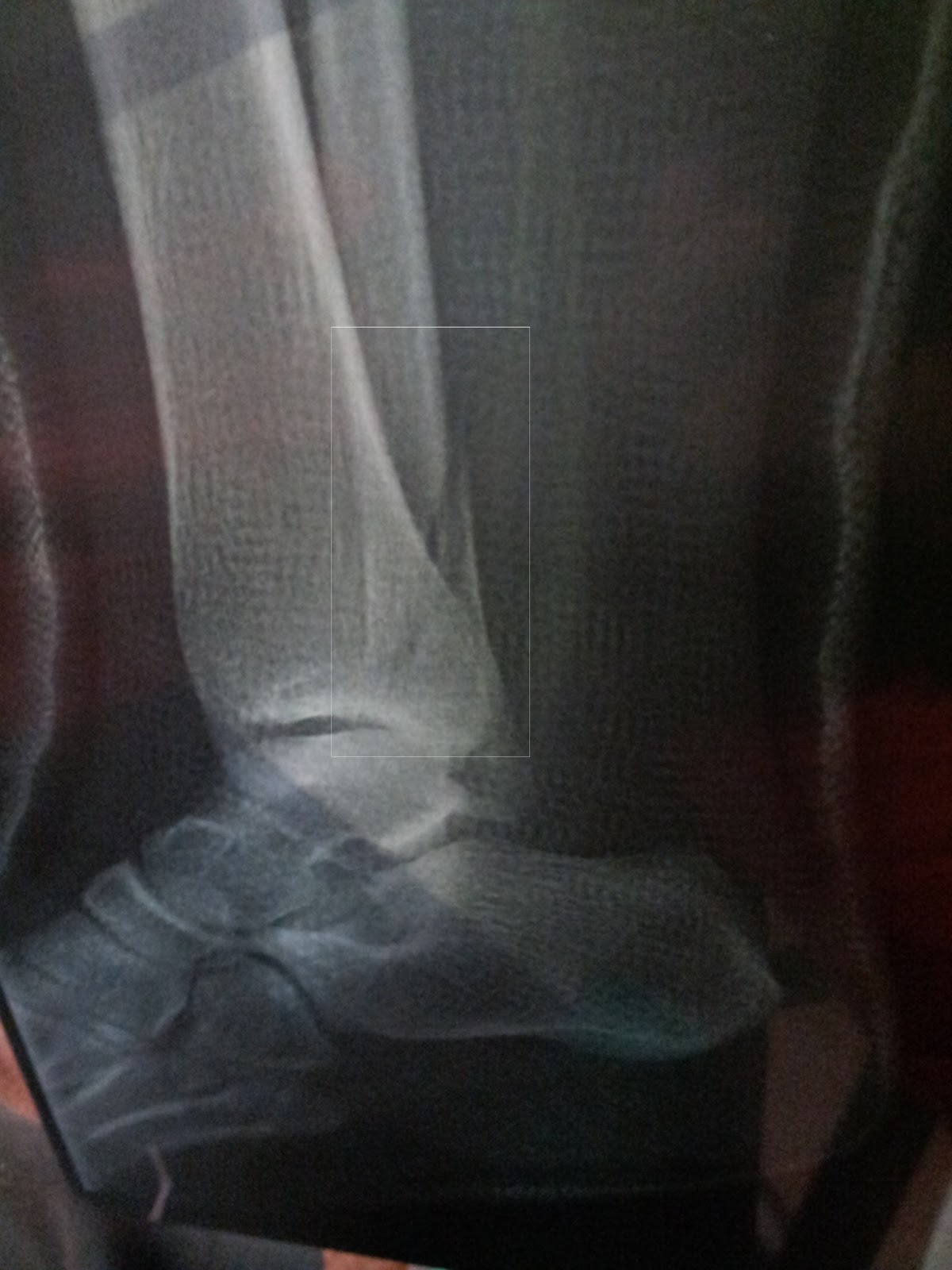 Kisah Patah Kaki | Adah Hamidah