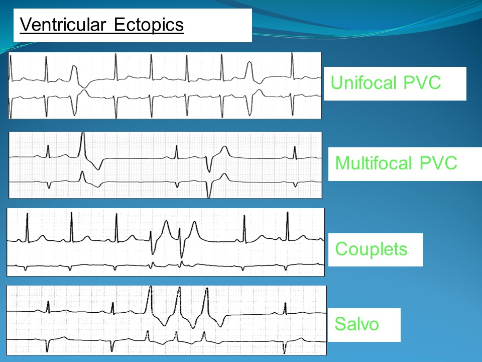 CVT Mohd Farid: Electrocardiogram ECG Part II Common Abnormalities Part I