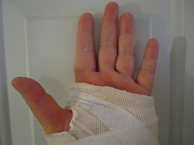 Oh My Aches and Pains!: Wordless Wednesday: Carpal Tunnel Surgery x2
