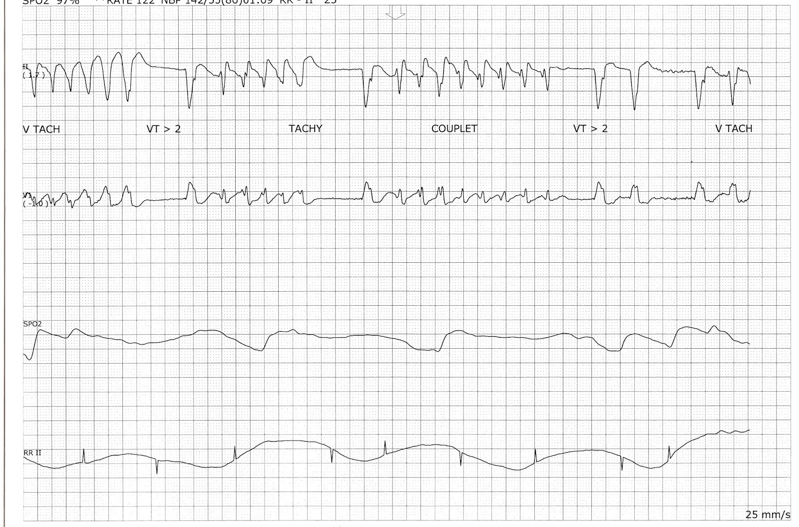 Float Nurse: Polymorphic Ventricular Tachycardia