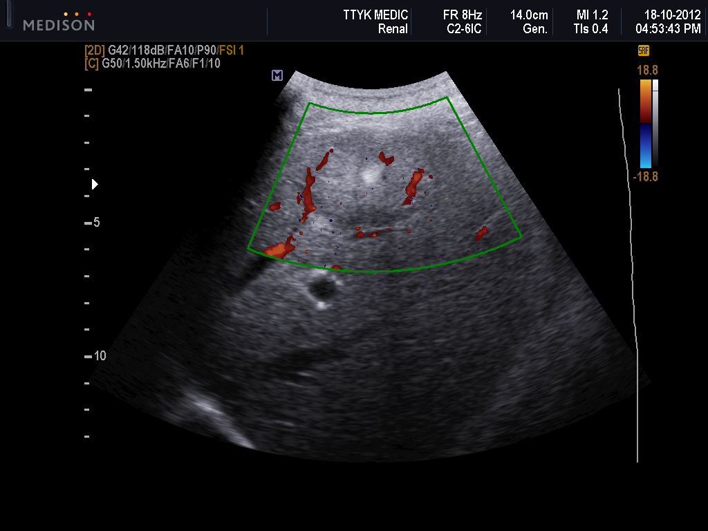 Liver Cancer: Liver Cancer Ultrasound