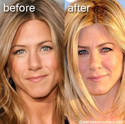 Jennifer Aniston Plastic Surgery Before and After Nose Job and Facelift ...