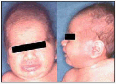 NOSOLOGIA CABEZA: PAROTIDITIS