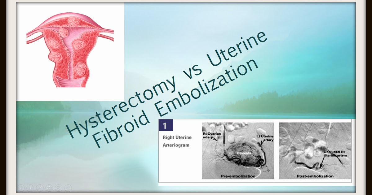 Ob/Gyn Updated : An effective, minimal invasive but “vastly ...