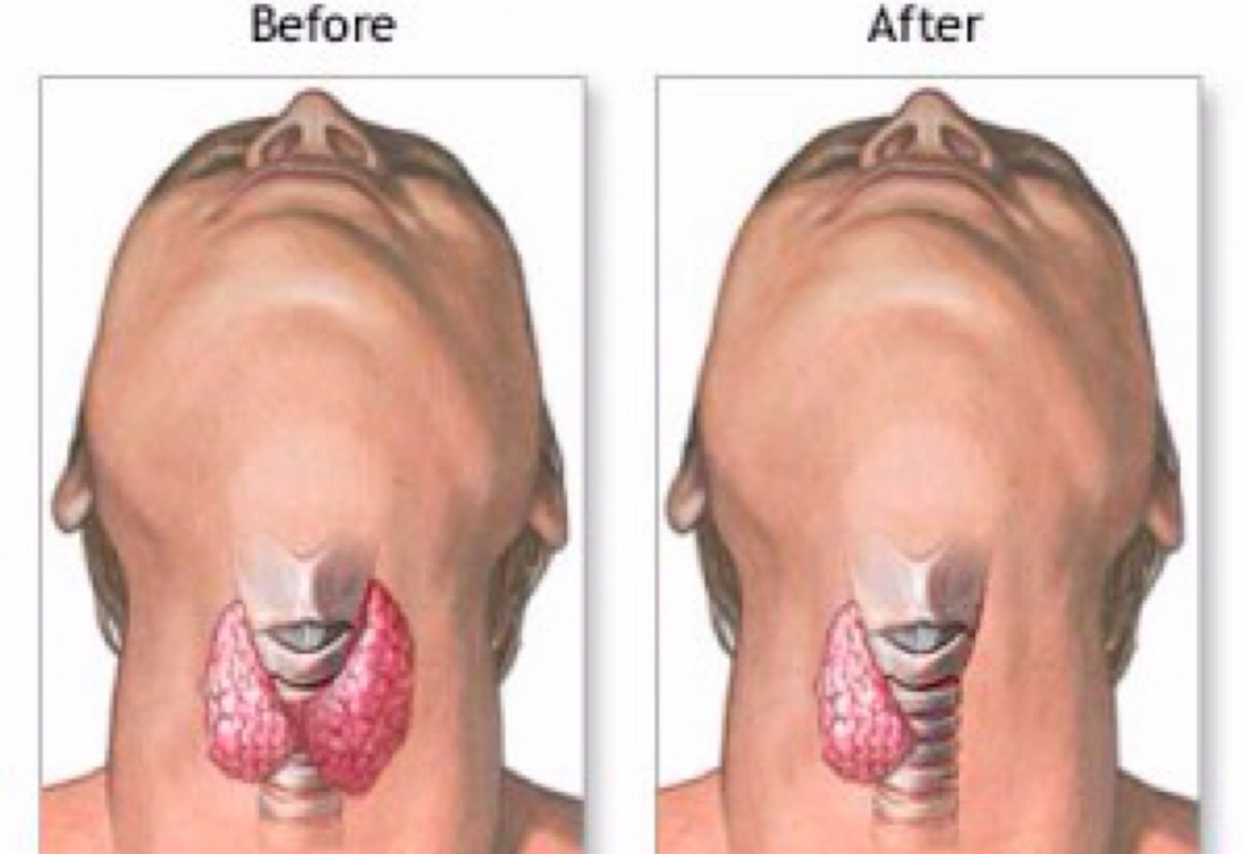 Câncer de tireóide - Causas e sintomas do câncer de tireóide - Artigos ...