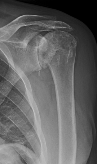 Shoulder Arthritis/Joint Replacement Rotator cuff tears: Is ...