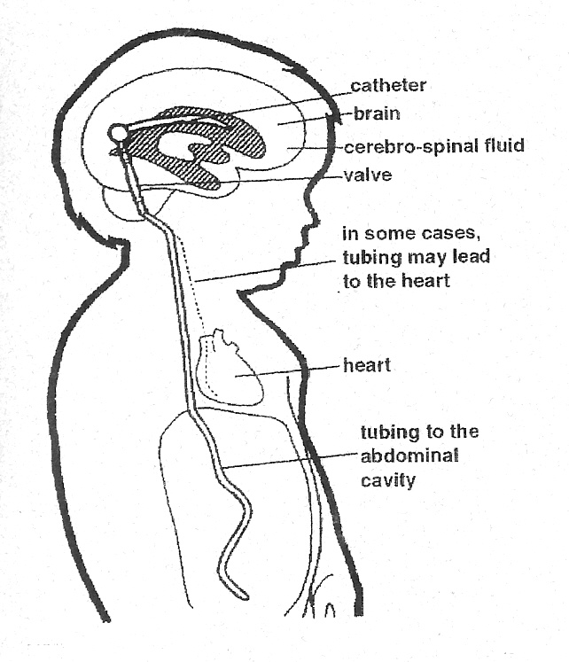 Schizencephaly: Carver's Journey: Carver's Shunt Surgery
