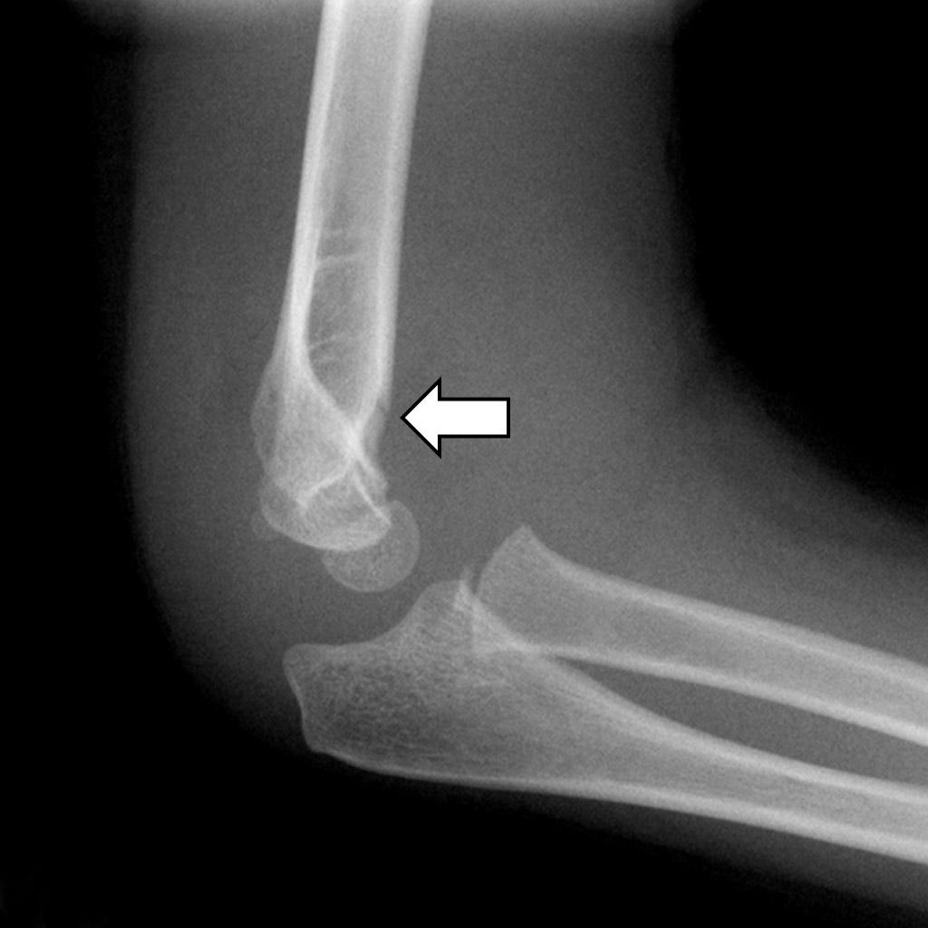 Cortex Medx (nanonotes): Supracondylar Humerus Fracture