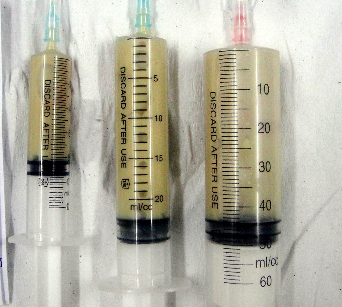 VIETNAMESE MEDIC ULTRASOUND: CASE 136: COLD ABSCESS, Dr PHAN THANH HẢI ...