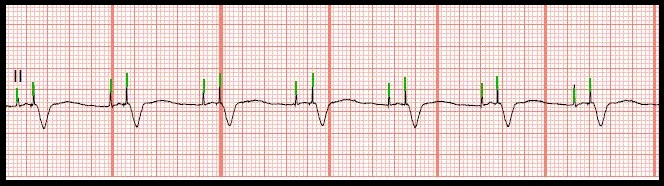 Float Nurse: EKG Rhythm Strip Quiz 161