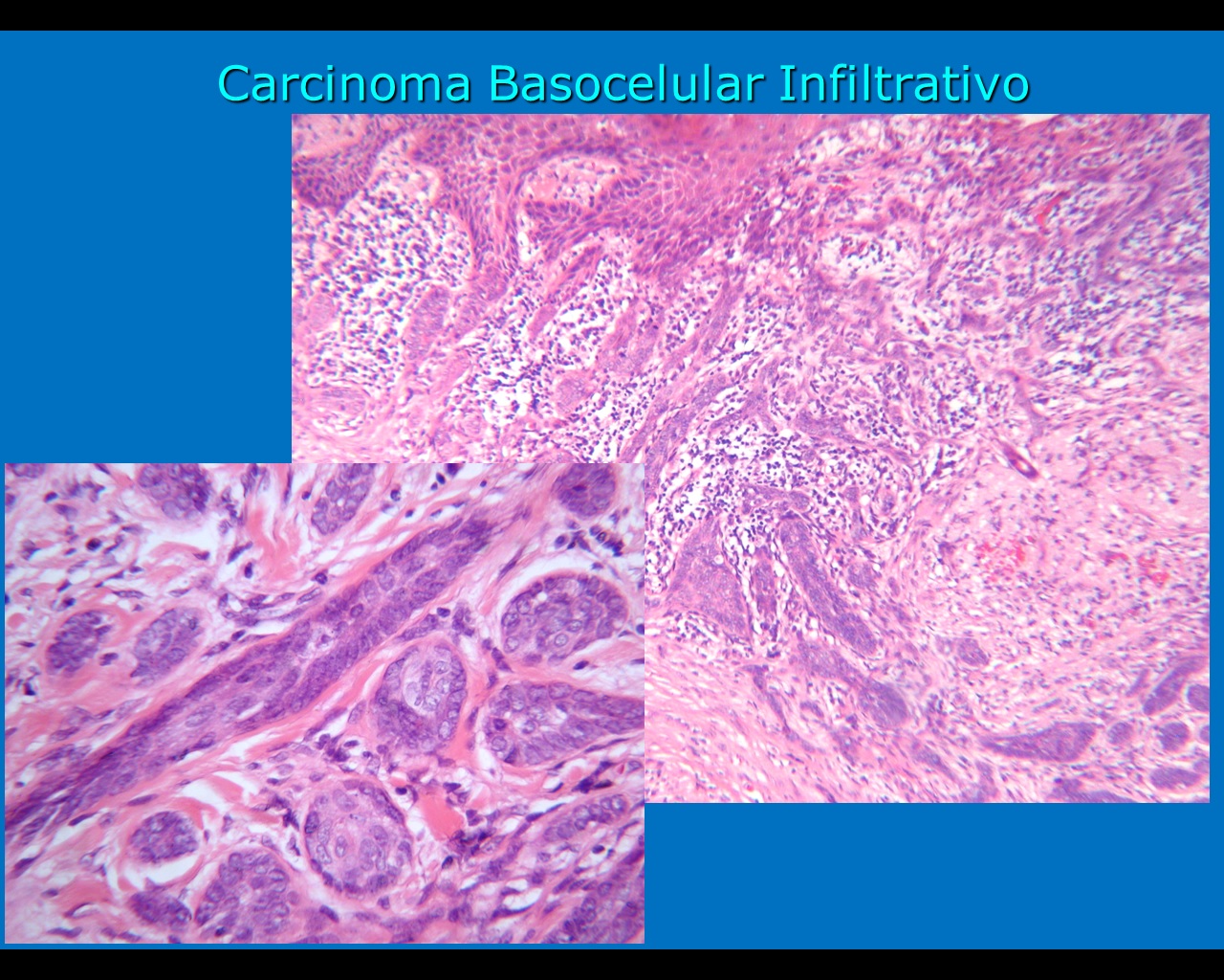 Dermatopatologia: CARCINOMA BASOCELULAR