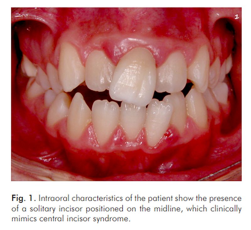 PDF: Dental trauma clinically mimicking single central incisor syndrome ...