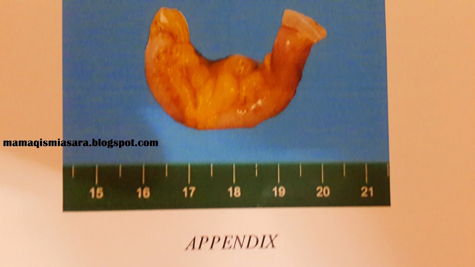 its All aBout mY sELf,mR.fAhZaL & lil qIstiNa: Gambar Cyst