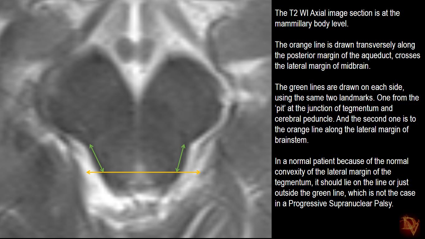 Ultimate Radiology : 'Hummingbird and Morning Glory' of Radiology