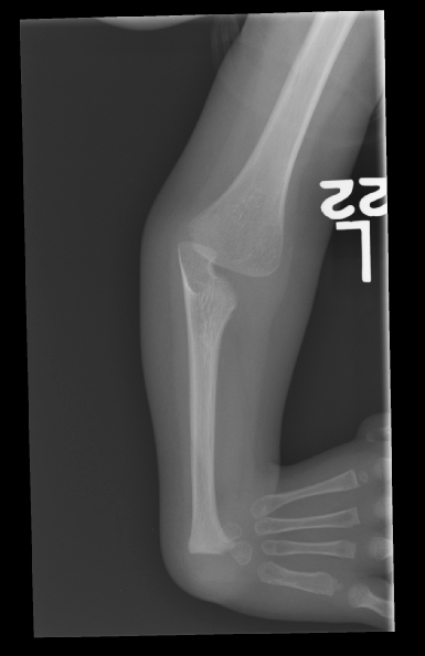 Severe Radial Deficiency- No slowing this kid down! | Congenital Hand ...